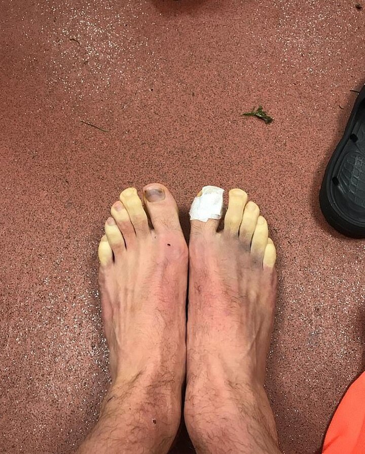 neymar feet bleeding